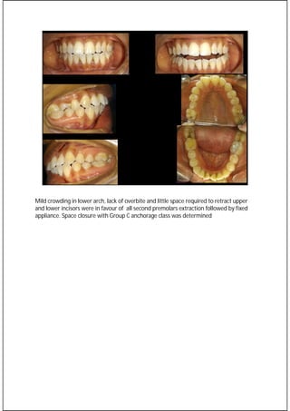 Orthodontic retraction biomechanics for space closure and distalization ...