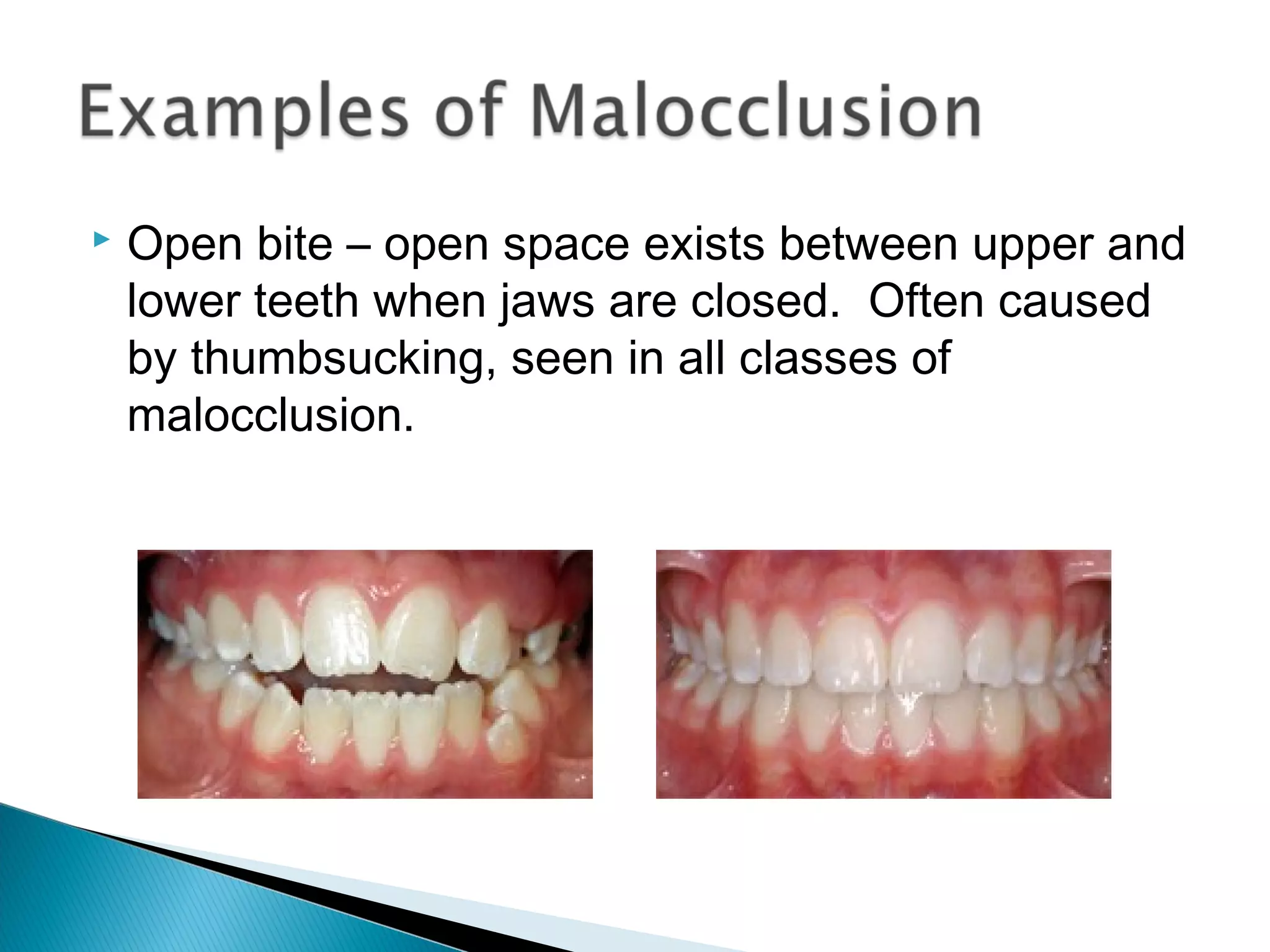 Intro To Orthodontics | PPT