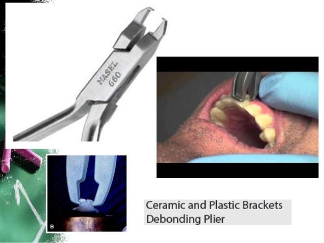 Orthodontics brackets removal