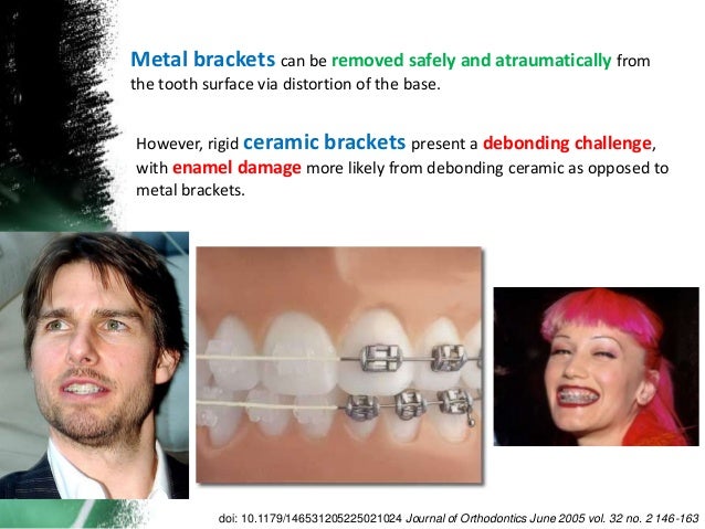 Orthodontics brackets removal