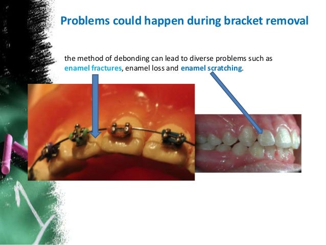 Orthodontics brackets removal