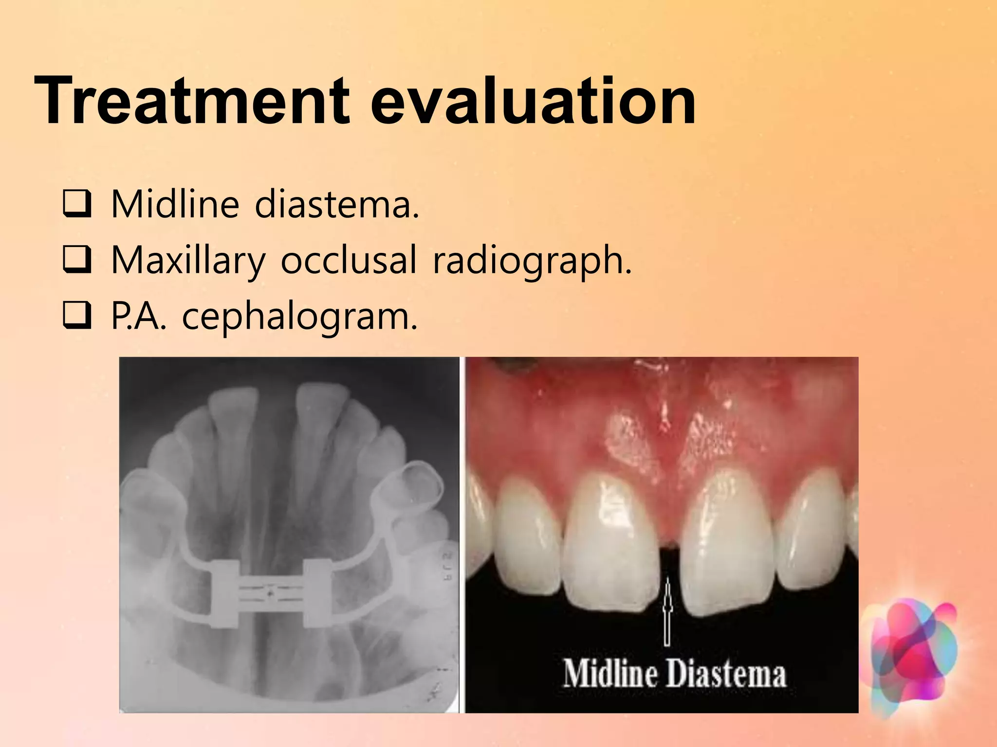 Introduction to maxillary arch expansion | PPTX
