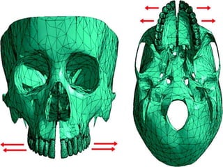 Introduction to maxillary arch expansion | PPTX
