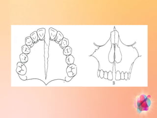 Introduction to maxillary arch expansion | PPTX