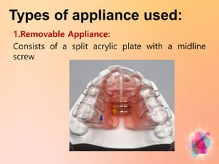 Introduction to maxillary arch expansion | PPTX