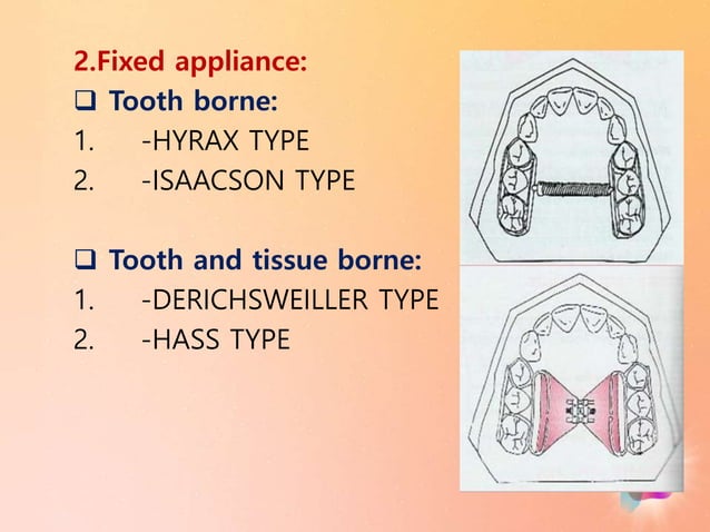 Introduction to maxillary arch expansion | PPTX