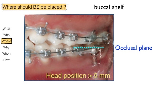WHERE TO PLACE A BONE SCREW.