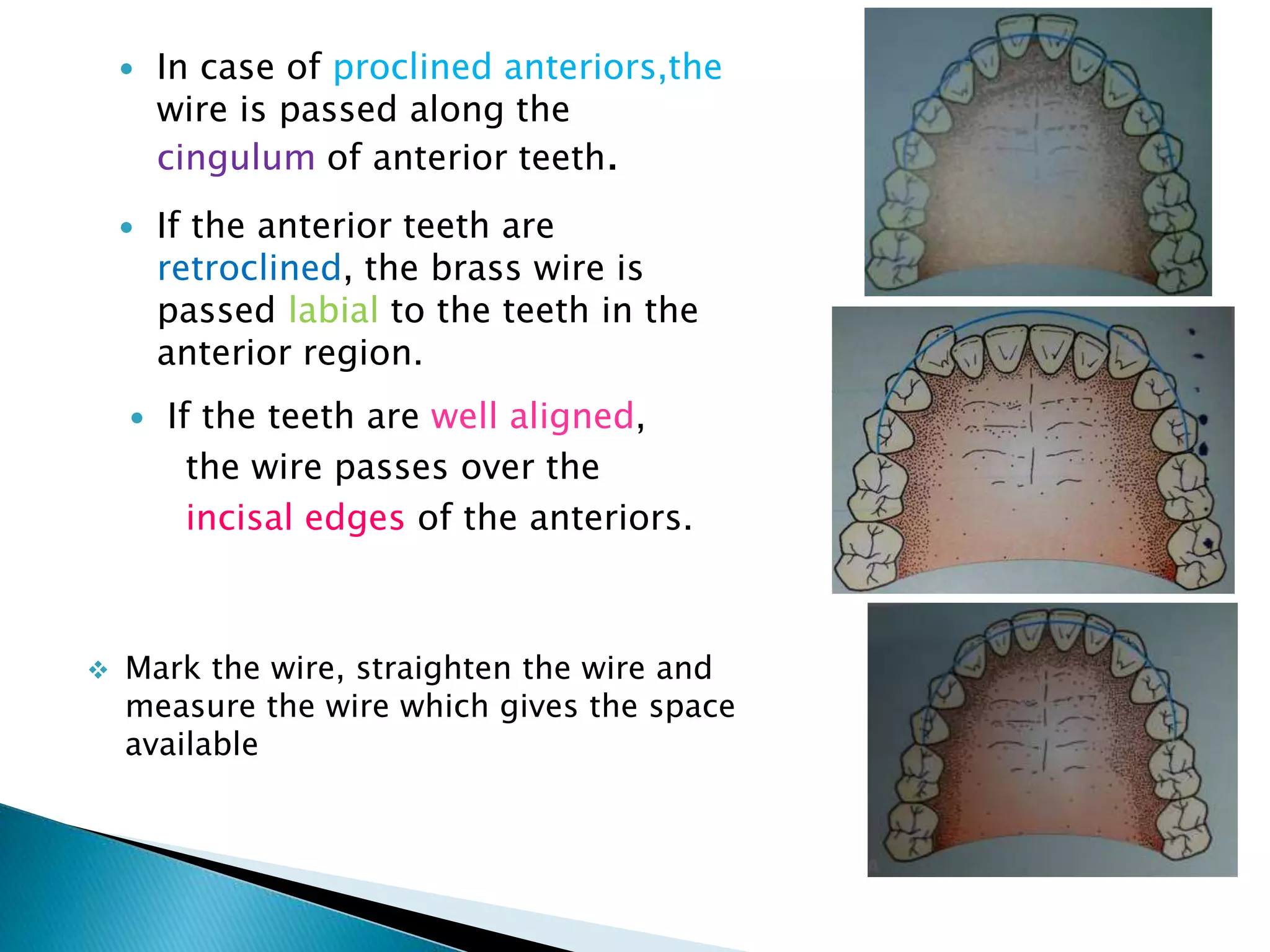 Orthodontic study model and model analysis | PPTX