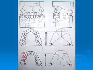 Orthodontic Study Models | PPT