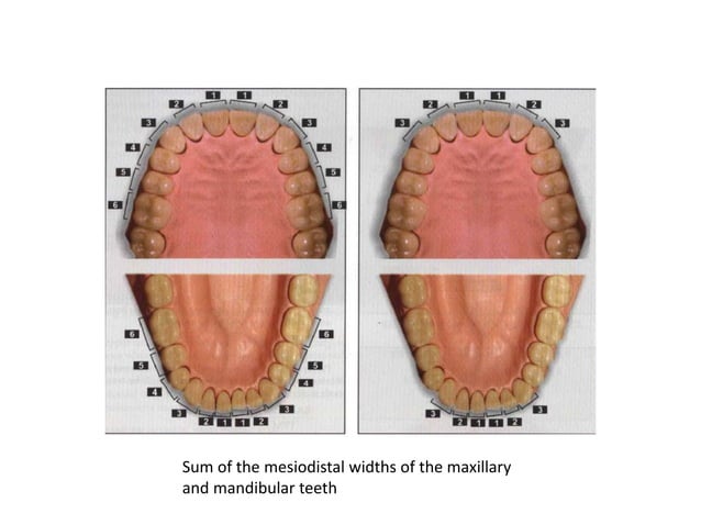 Orthodontic study models | PPT | Dental Health | Diseases and Conditions