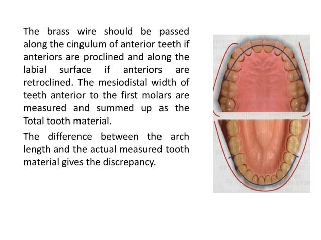 Orthodontic study models | PPT | Dental Health | Diseases and Conditions