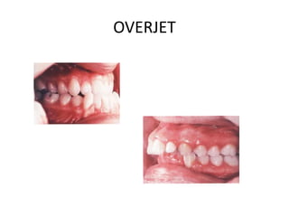 ORTHODONTIC TERMINOLOGIES.pptx