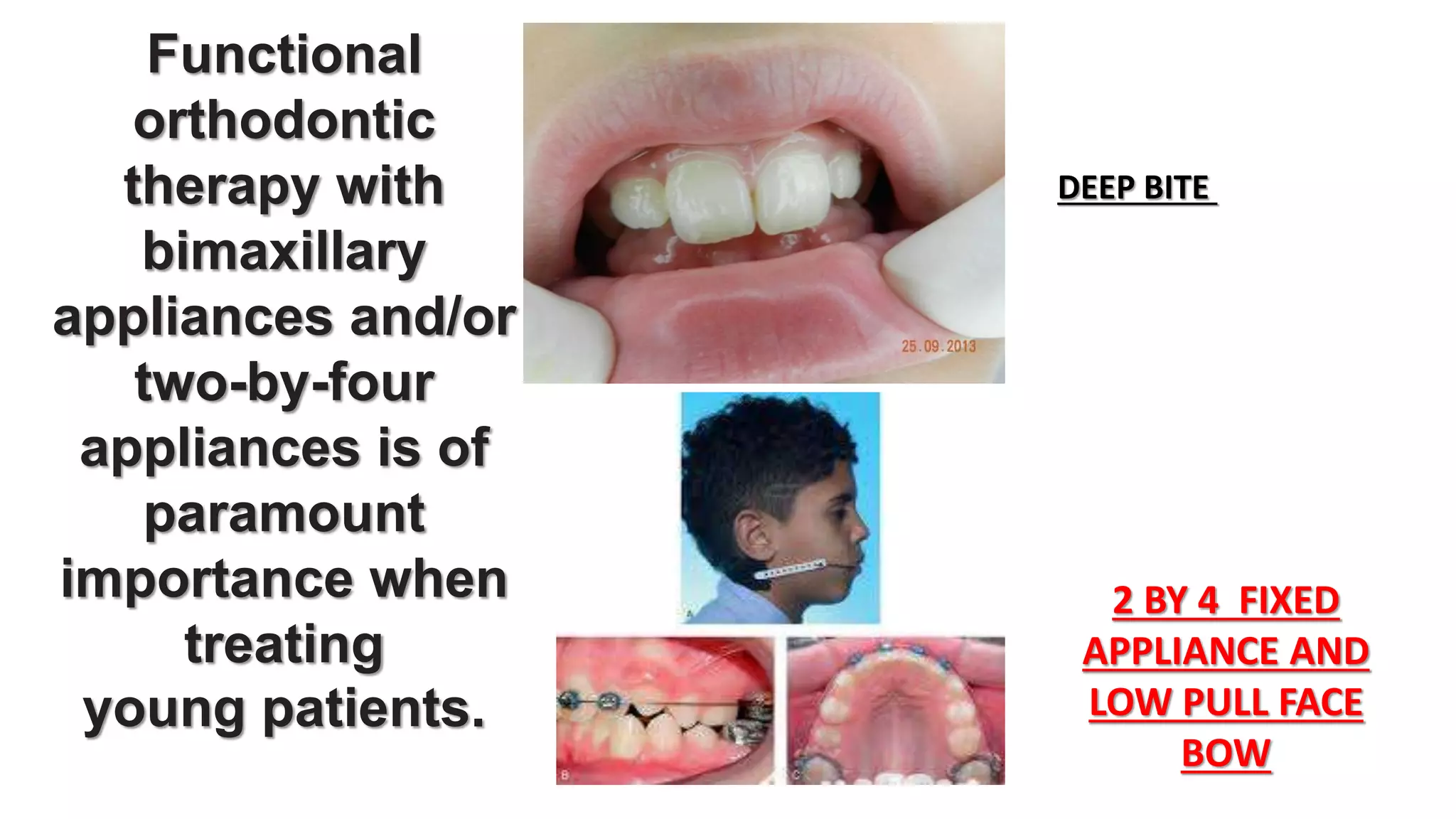 Orthodontic treatment of deep bite part 1 | PPTX