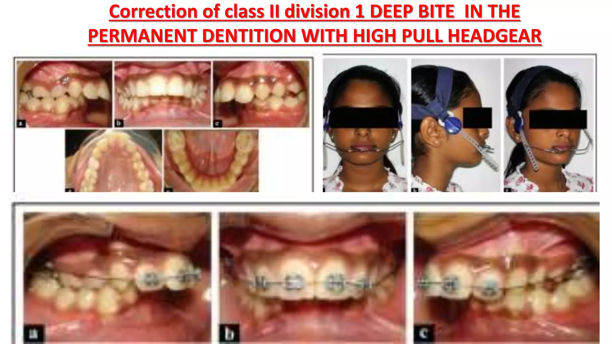 Orthodontic treatment of deep bite part 1 | PPTX | Oral care | Personal ...