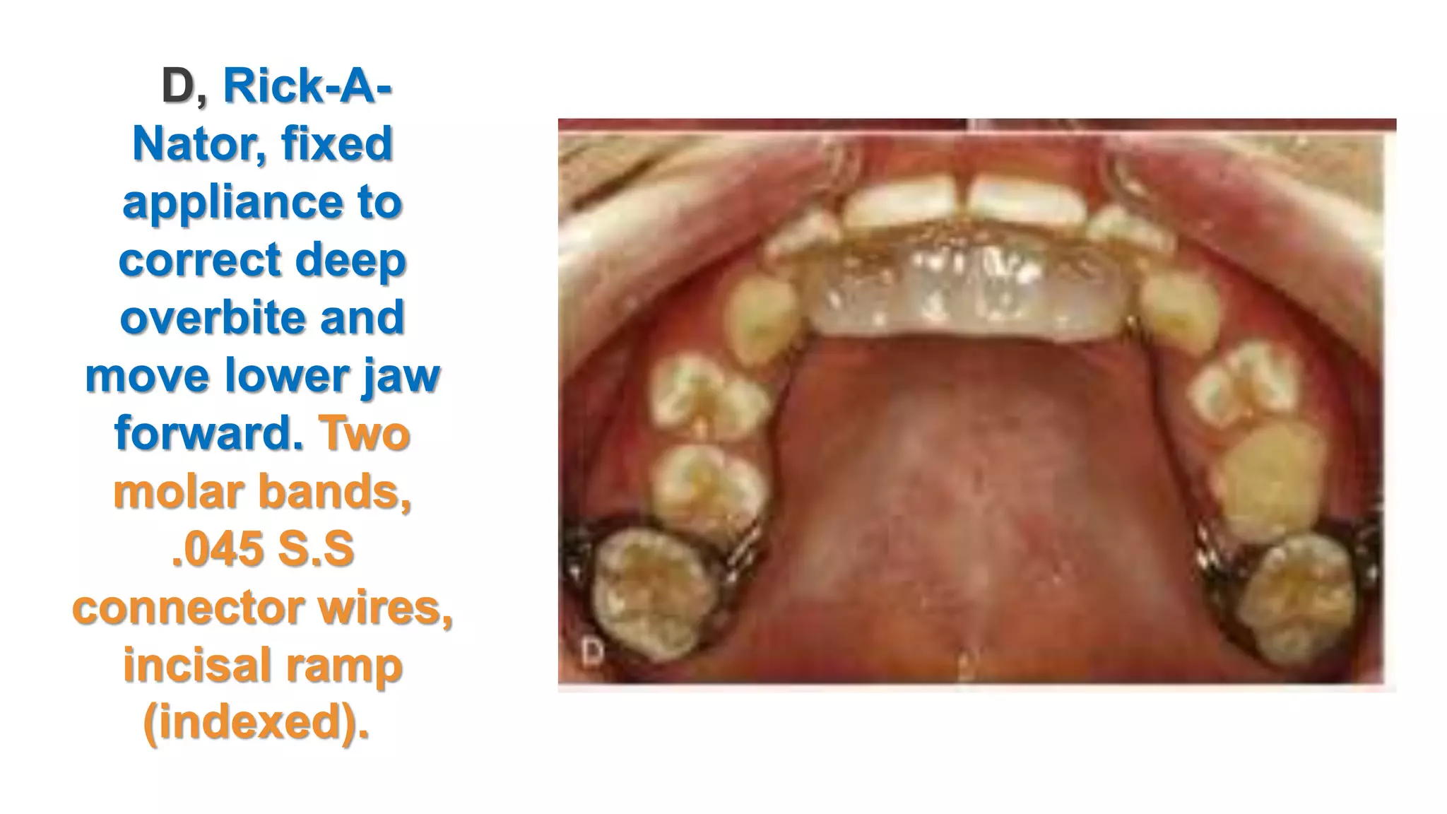 Orthodontic treatment of deep bite part 1 | PPTX
