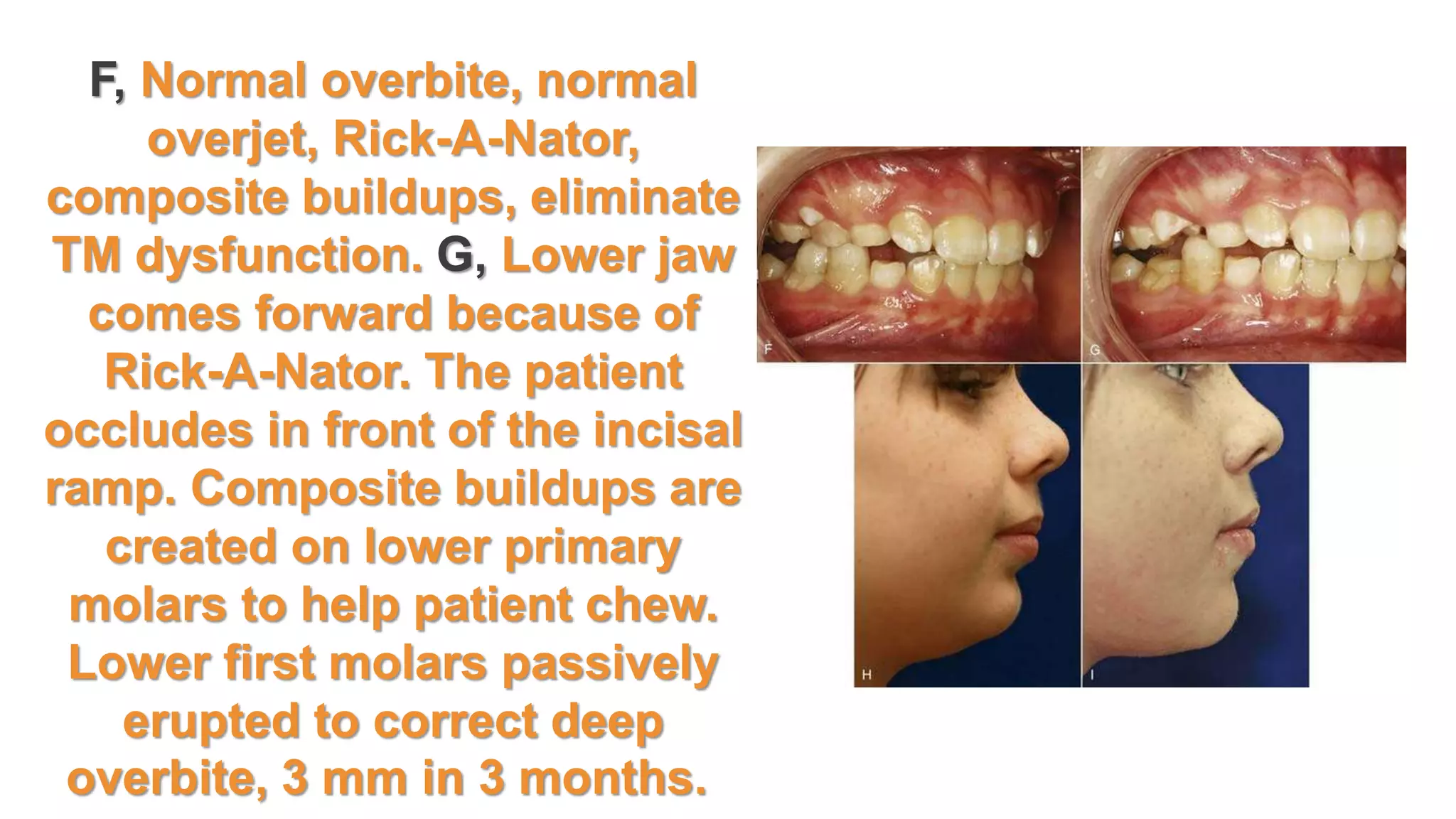 Orthodontic treatment of deep bite part 1 | PPTX