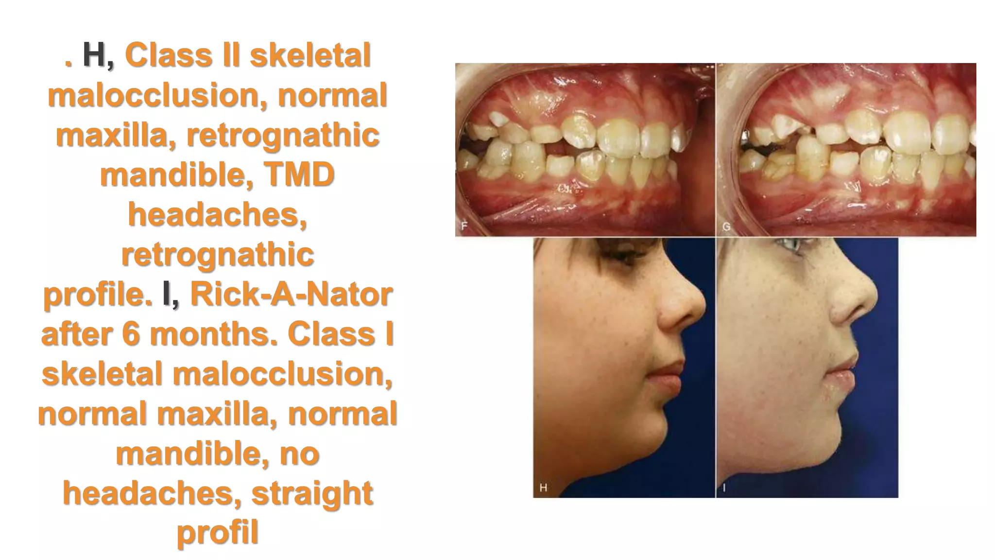 Orthodontic treatment of deep bite part 1 | PPTX
