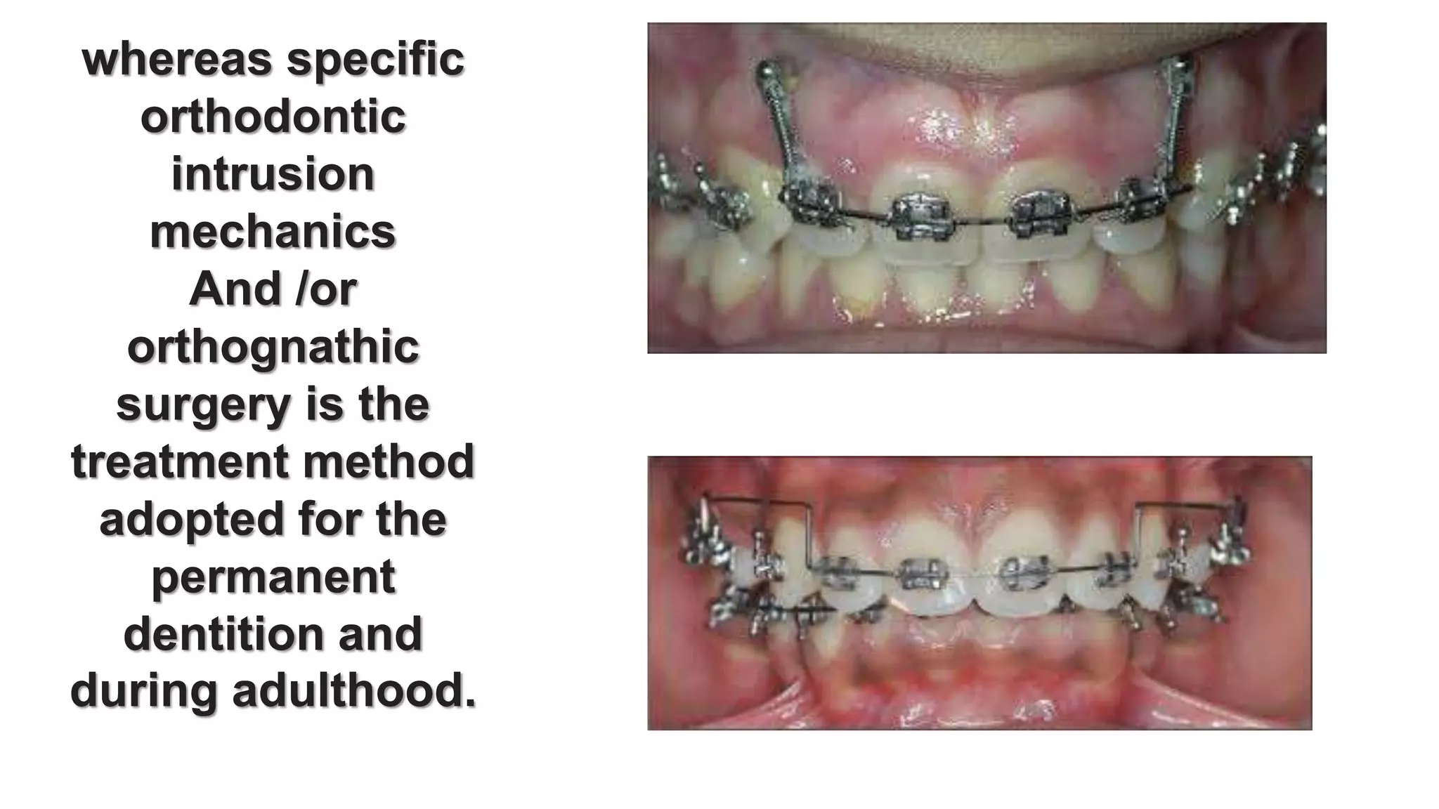 Orthodontic treatment of deep bite part 1 | PPTX