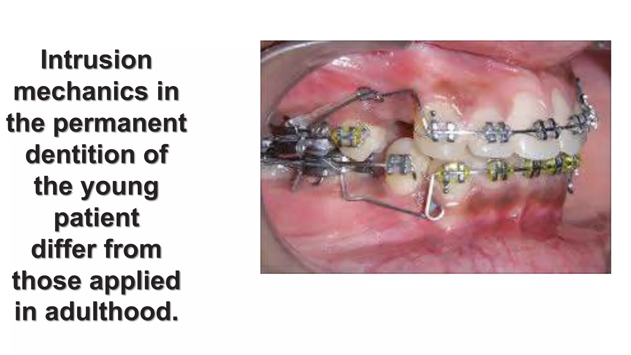 Orthodontic treatment of deep bite part 1 | PPTX | Oral care | Personal Care