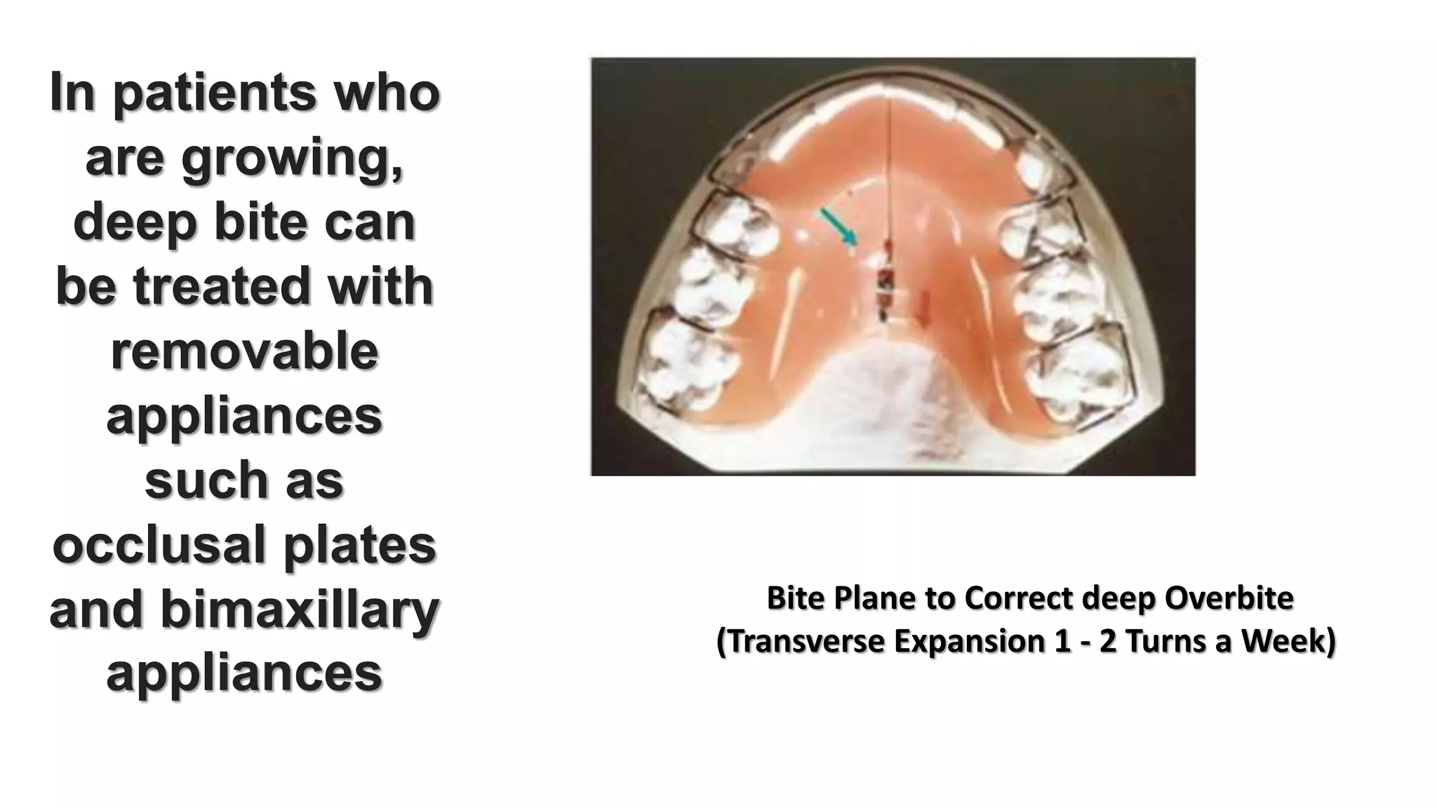 Orthodontic treatment of deep bite part 1 | PPTX