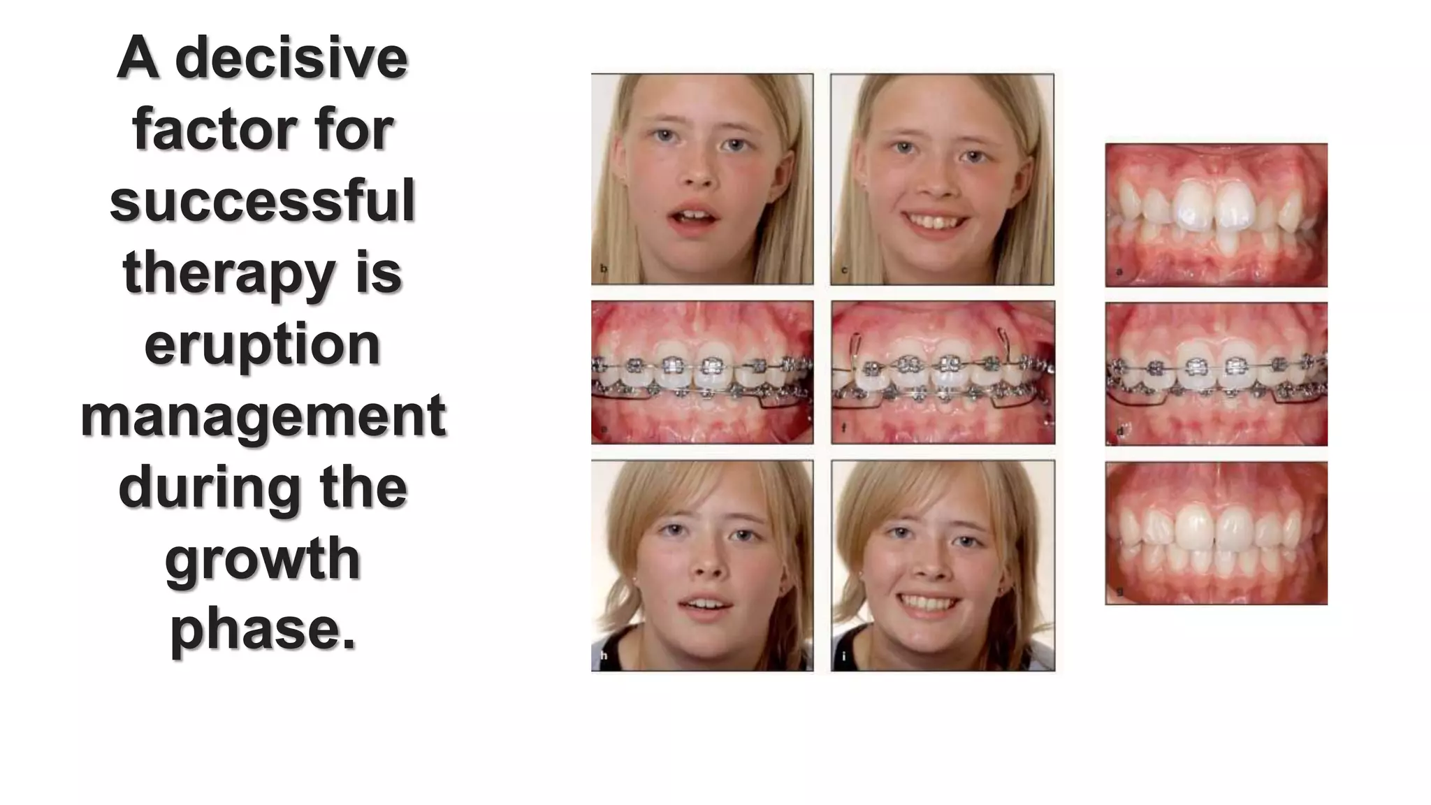 Orthodontic treatment of deep bite part 1 | PPTX