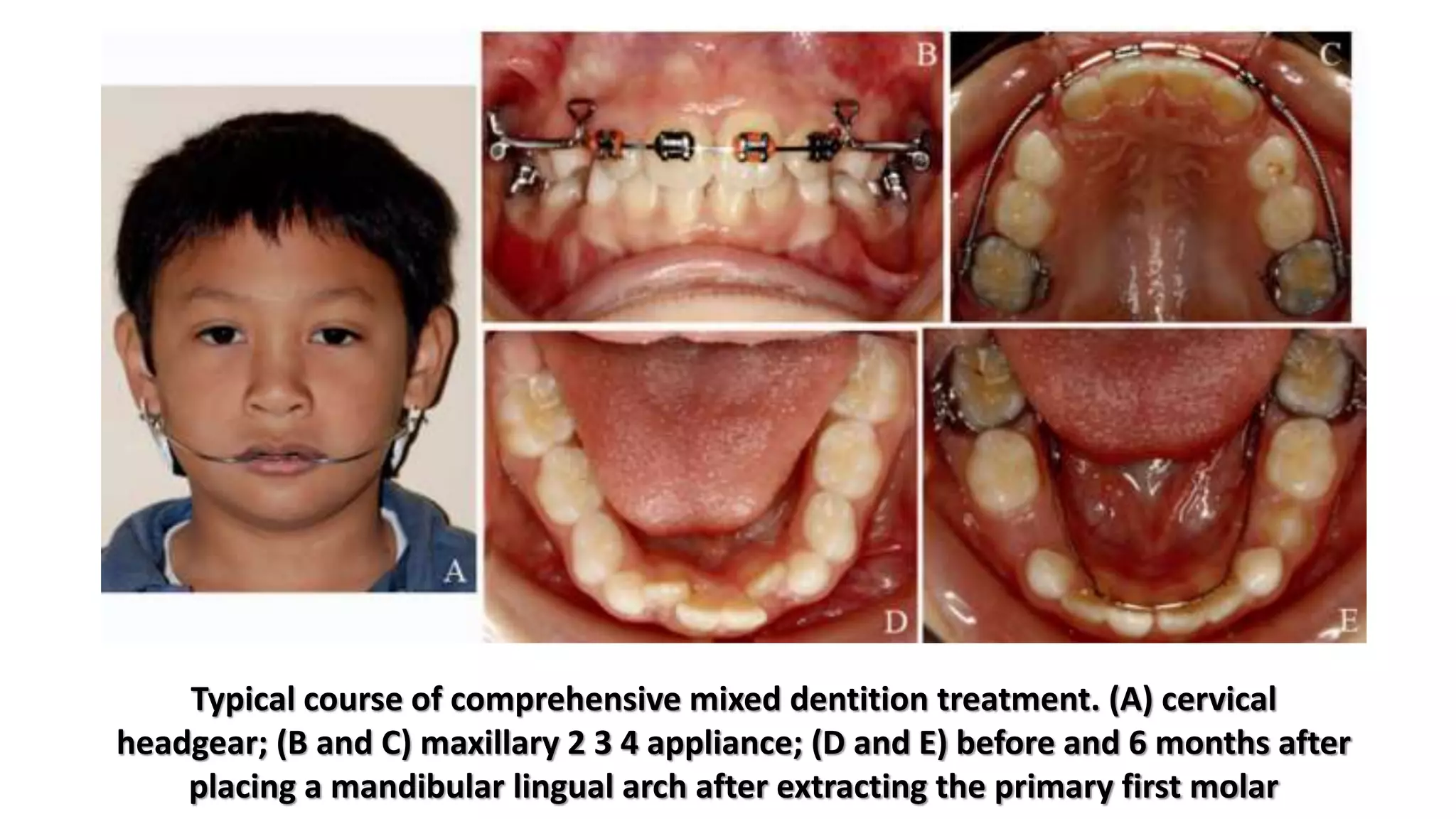 Orthodontic treatment of deep bite part 1 | PPTX | Oral care | Personal Care
