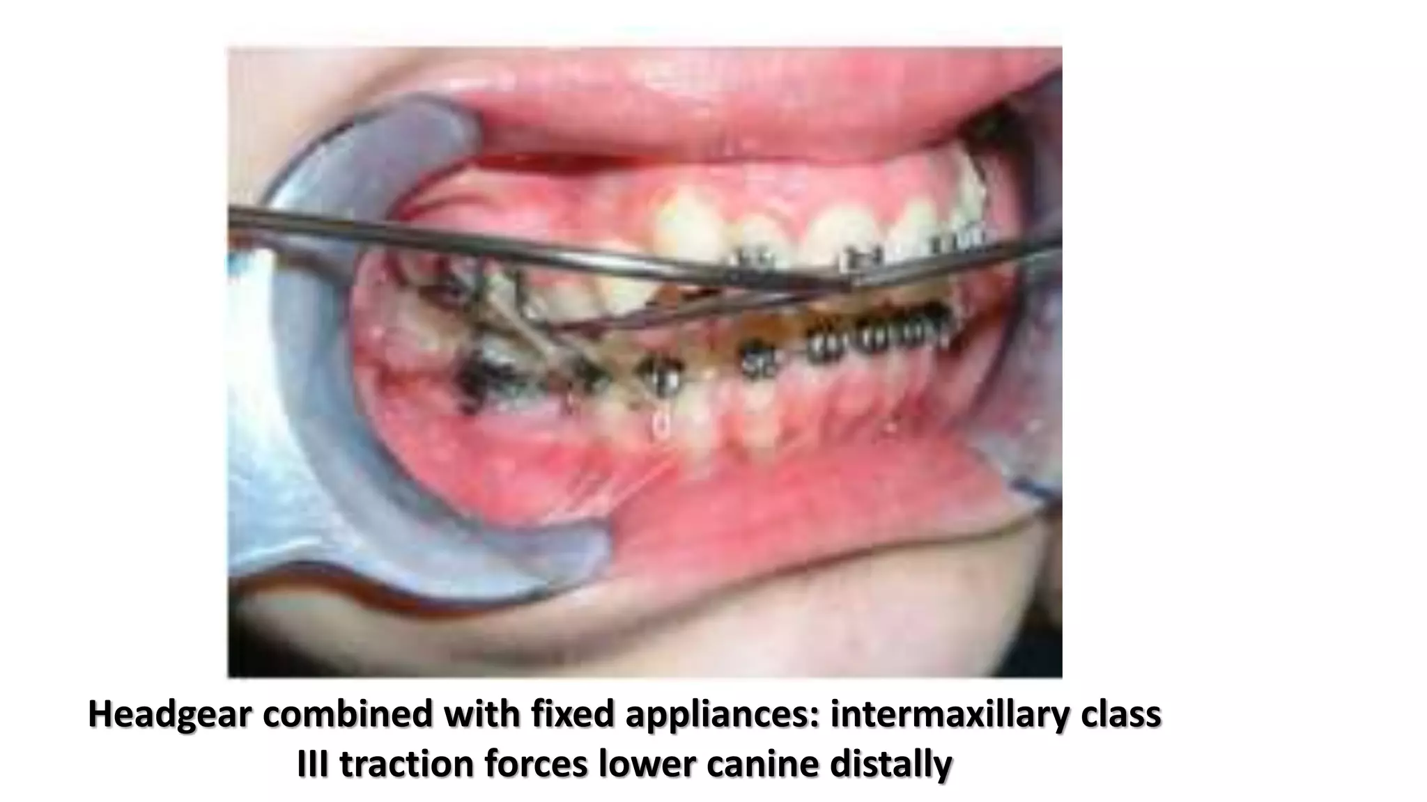Orthodontic treatment of deep bite part 1 | PPTX
