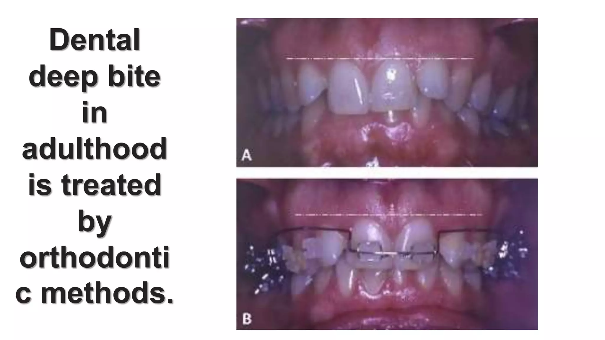 Orthodontic treatment of deep bite part 1 | PPTX