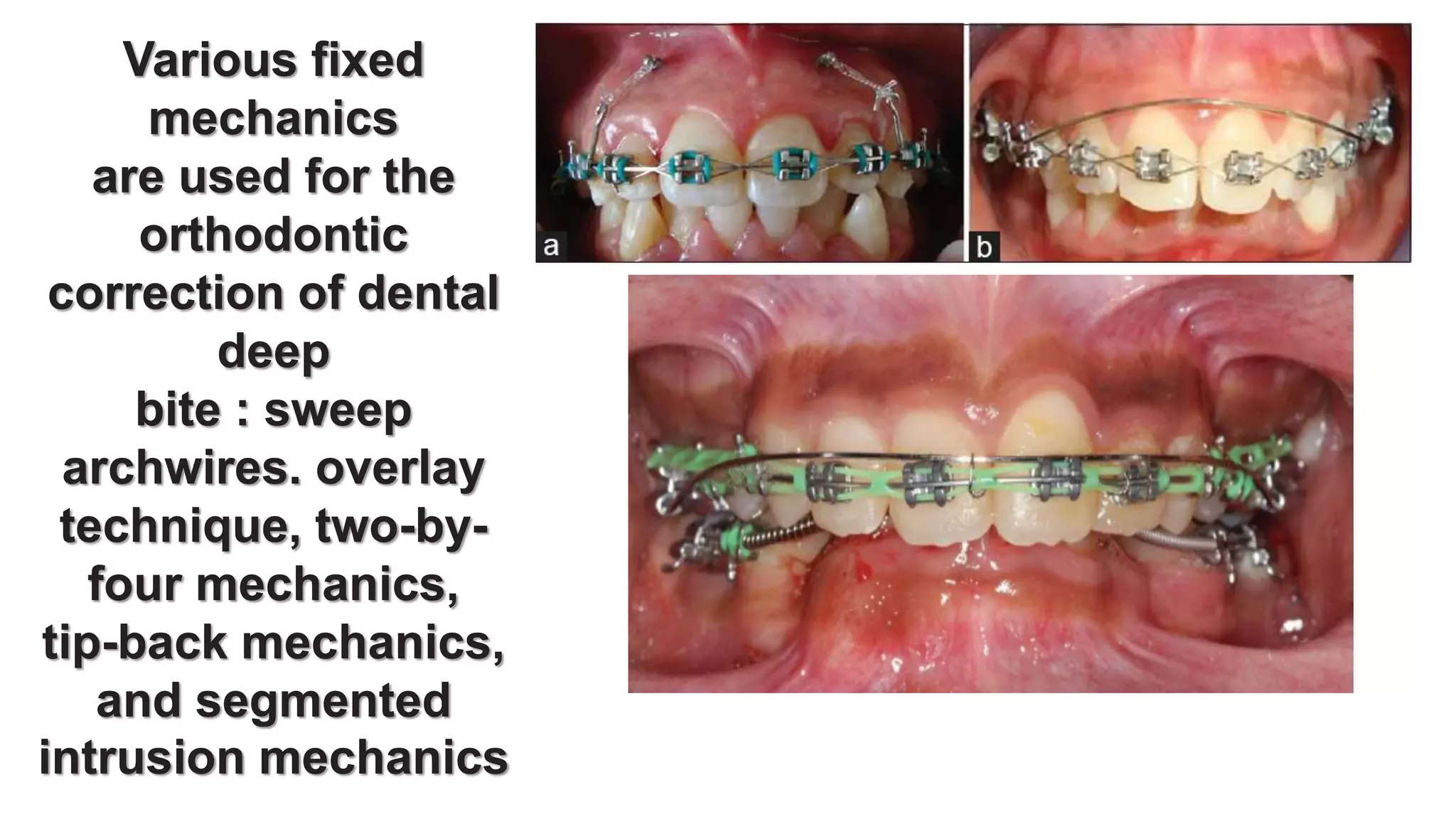 Orthodontic treatment of deep bite part 1 | PPTX