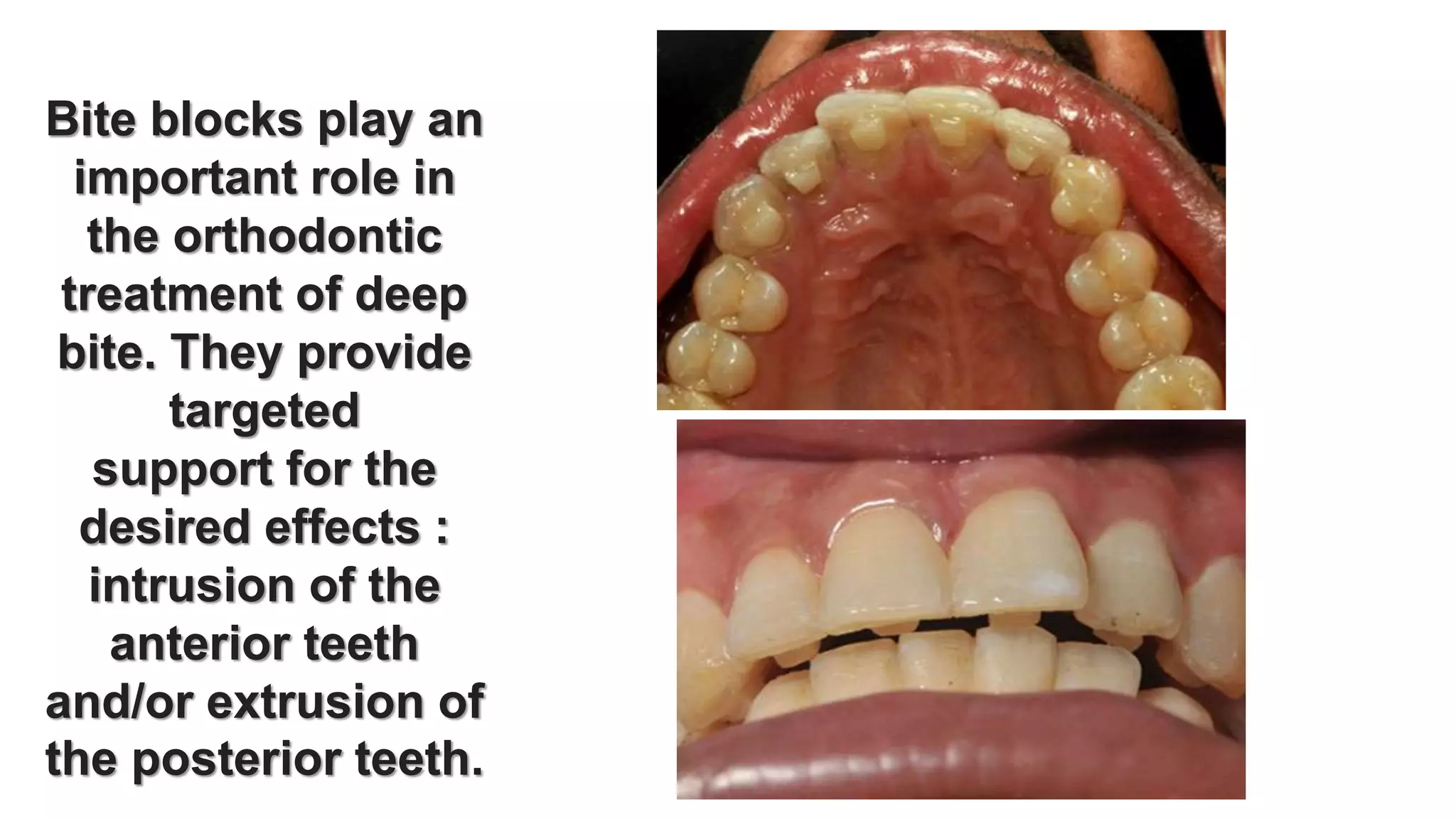 Orthodontic treatment of deep bite part 1 | PPTX