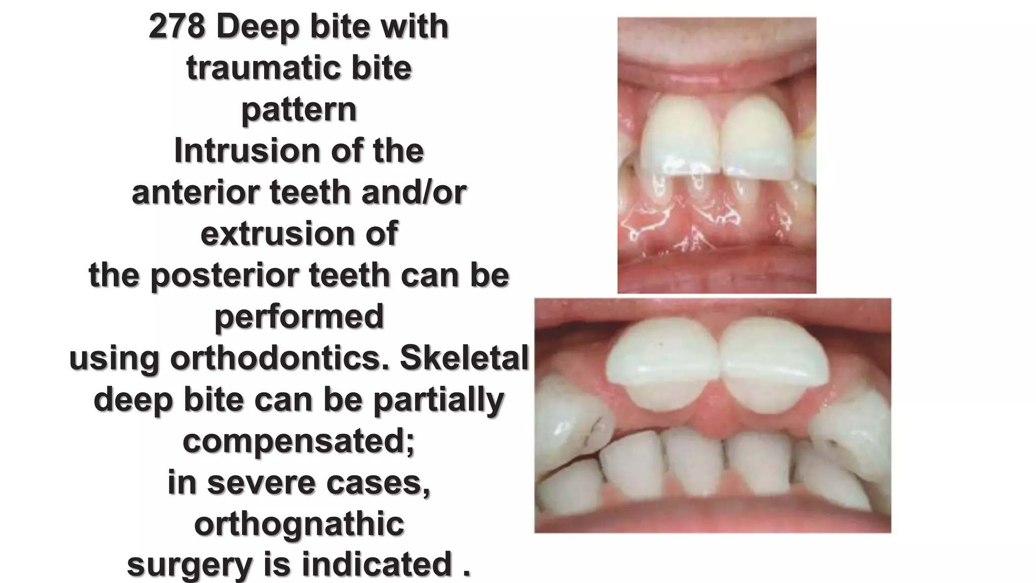 Orthodontic treatment of deep bite part 1 | PPTX