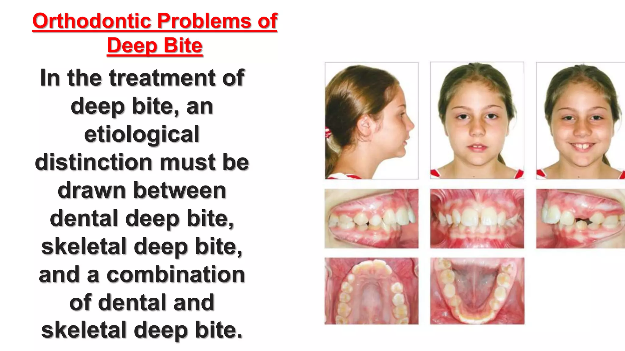 Orthodontic treatment of deep bite part 1 | PPTX | Oral care | Personal ...