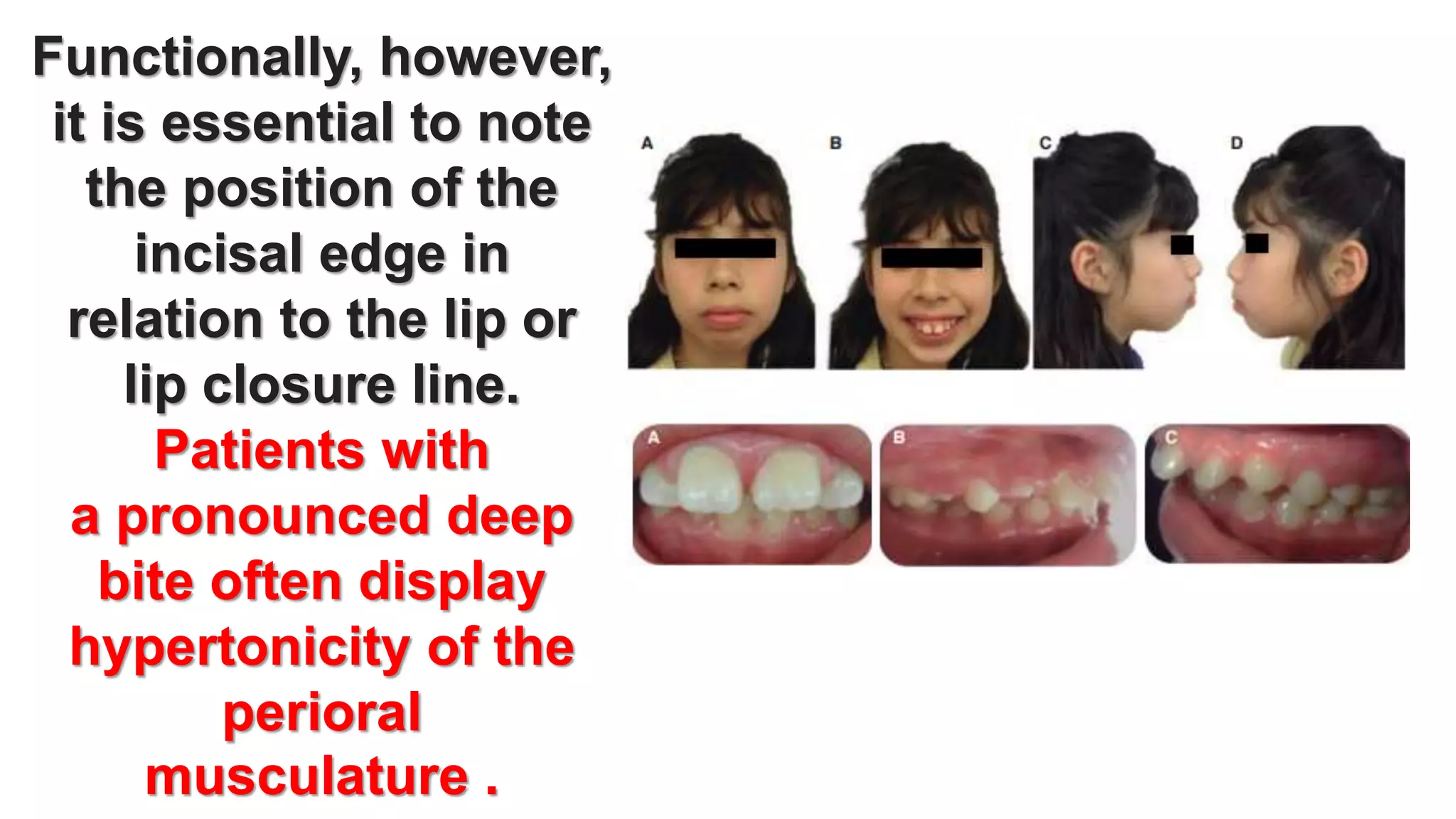 Orthodontic treatment of deep bite part 1 | PPTX