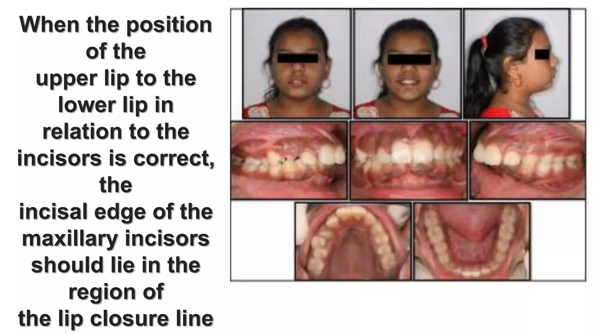 Orthodontic treatment of deep bite part 1 | PPTX