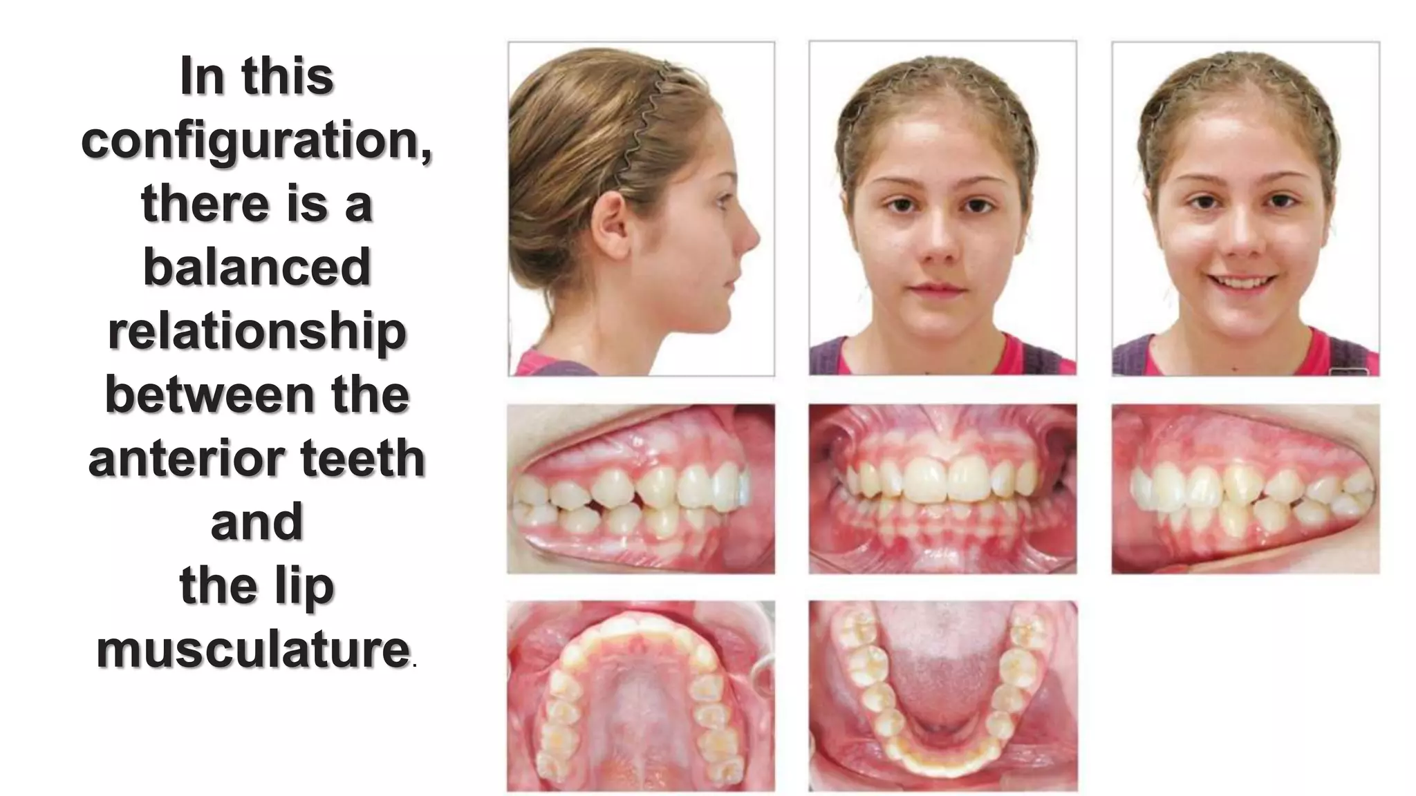 Orthodontic treatment of deep bite part 1 | PPTX