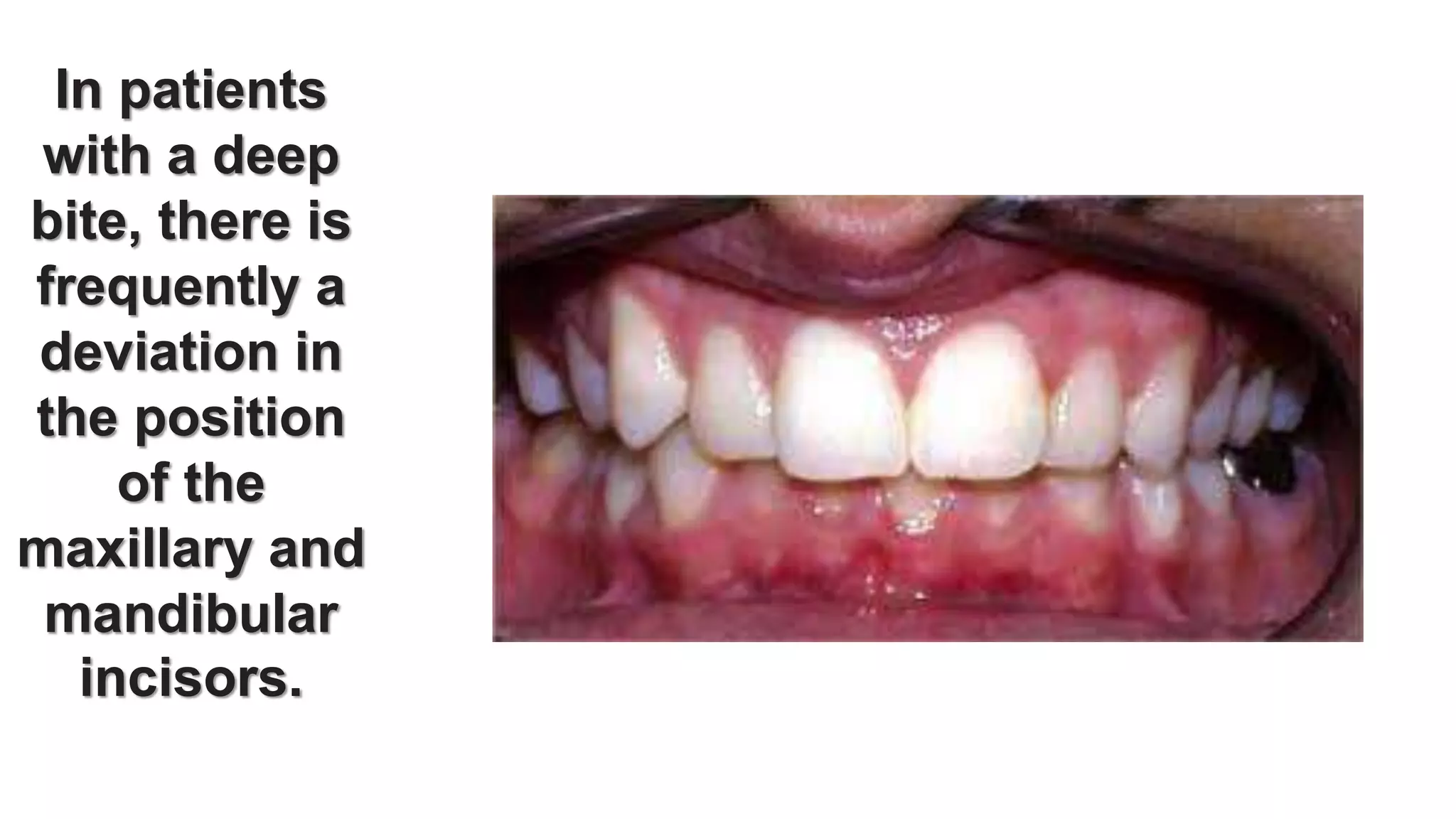 Orthodontic treatment of deep bite part 1 | PPTX