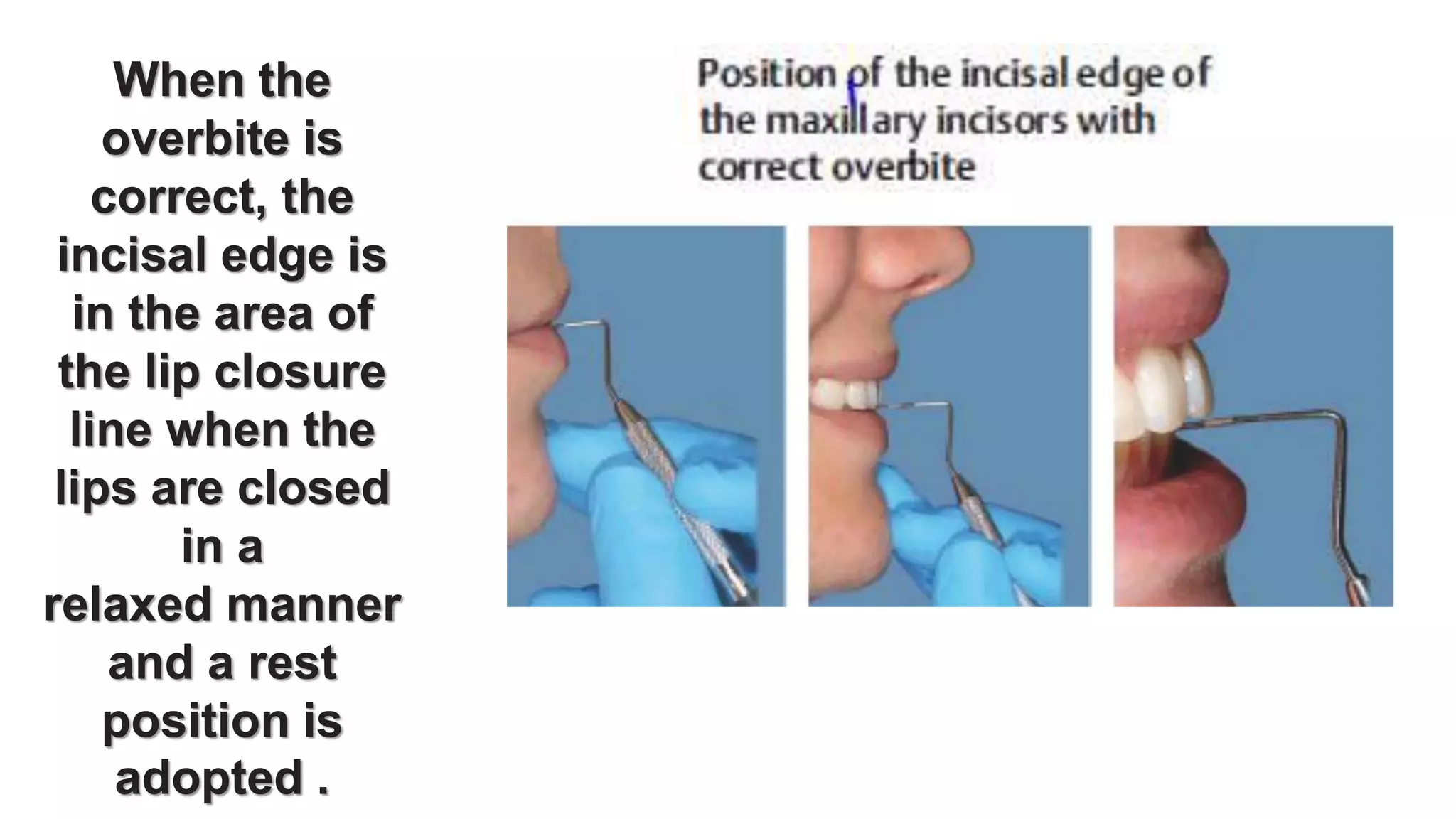 Orthodontic treatment of deep bite part 1 | PPTX