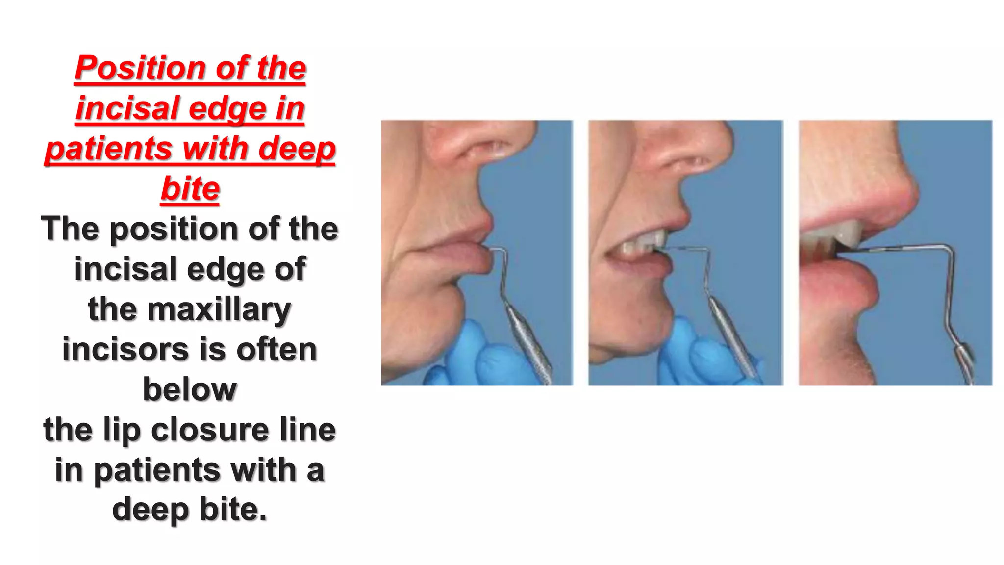 Orthodontic treatment of deep bite part 1 | PPTX | Oral care | Personal ...