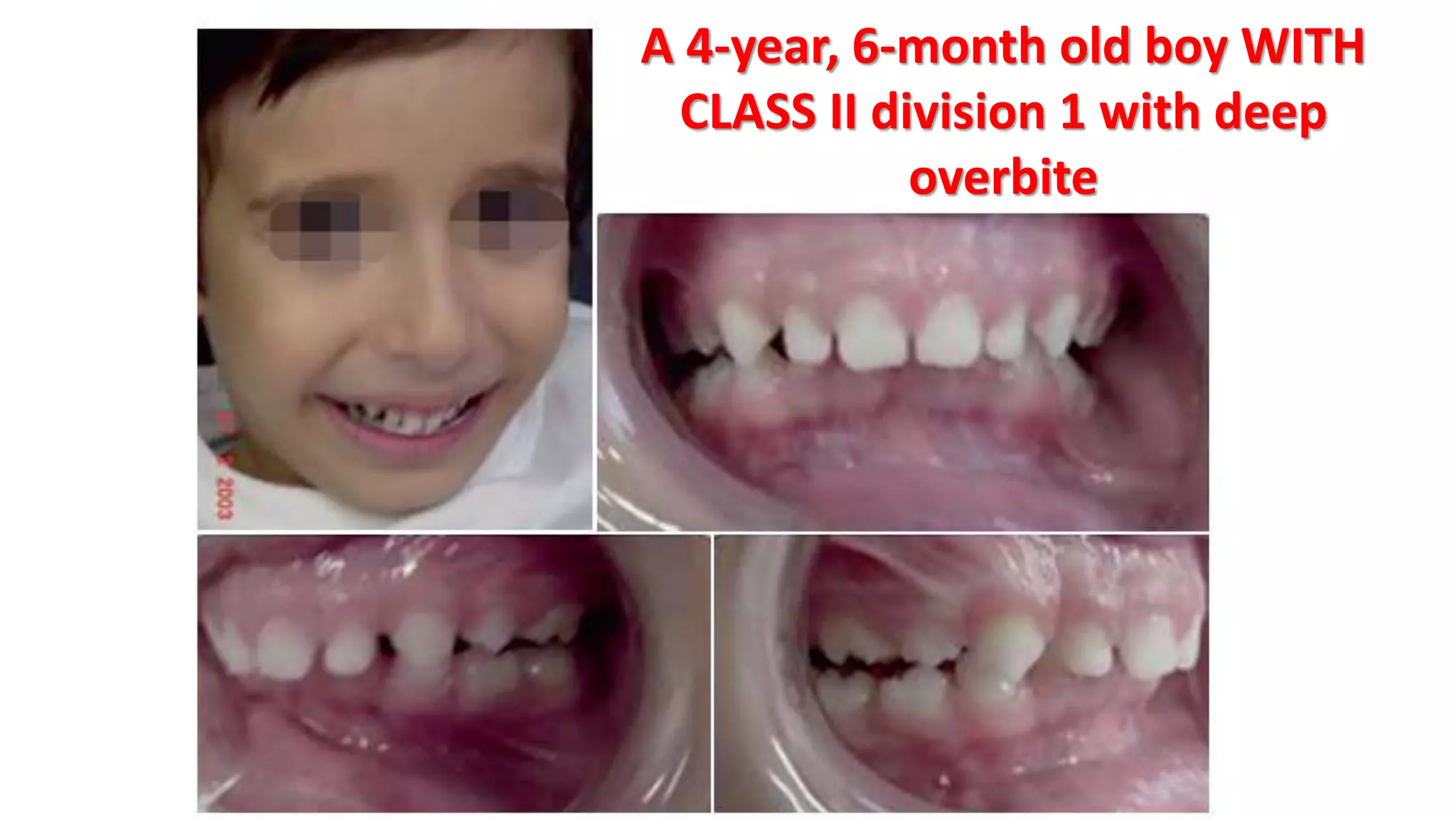 Orthodontic treatment of deep bite part 1 | PPTX | Oral care | Personal Care