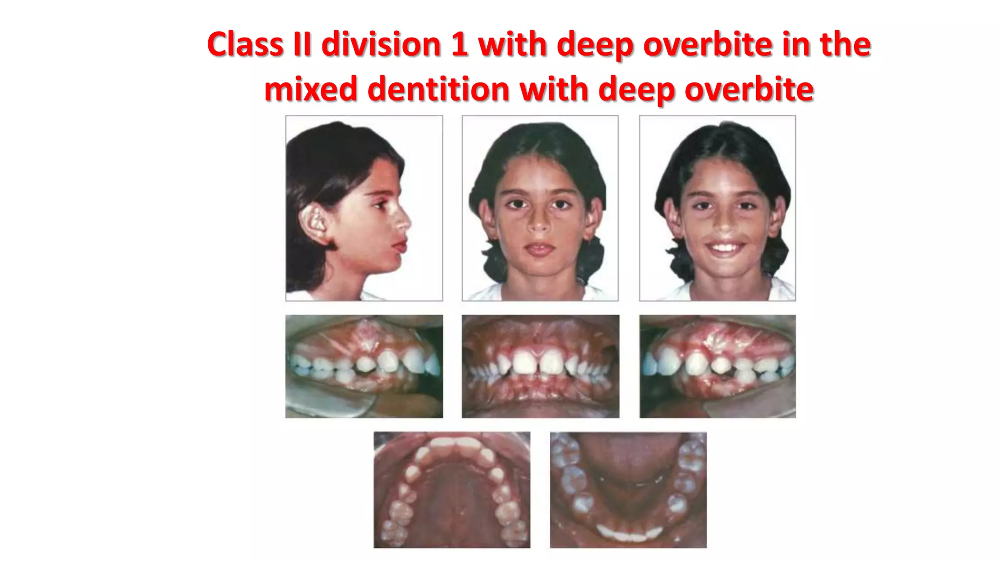 Orthodontic treatment of deep bite part 1 | PPTX