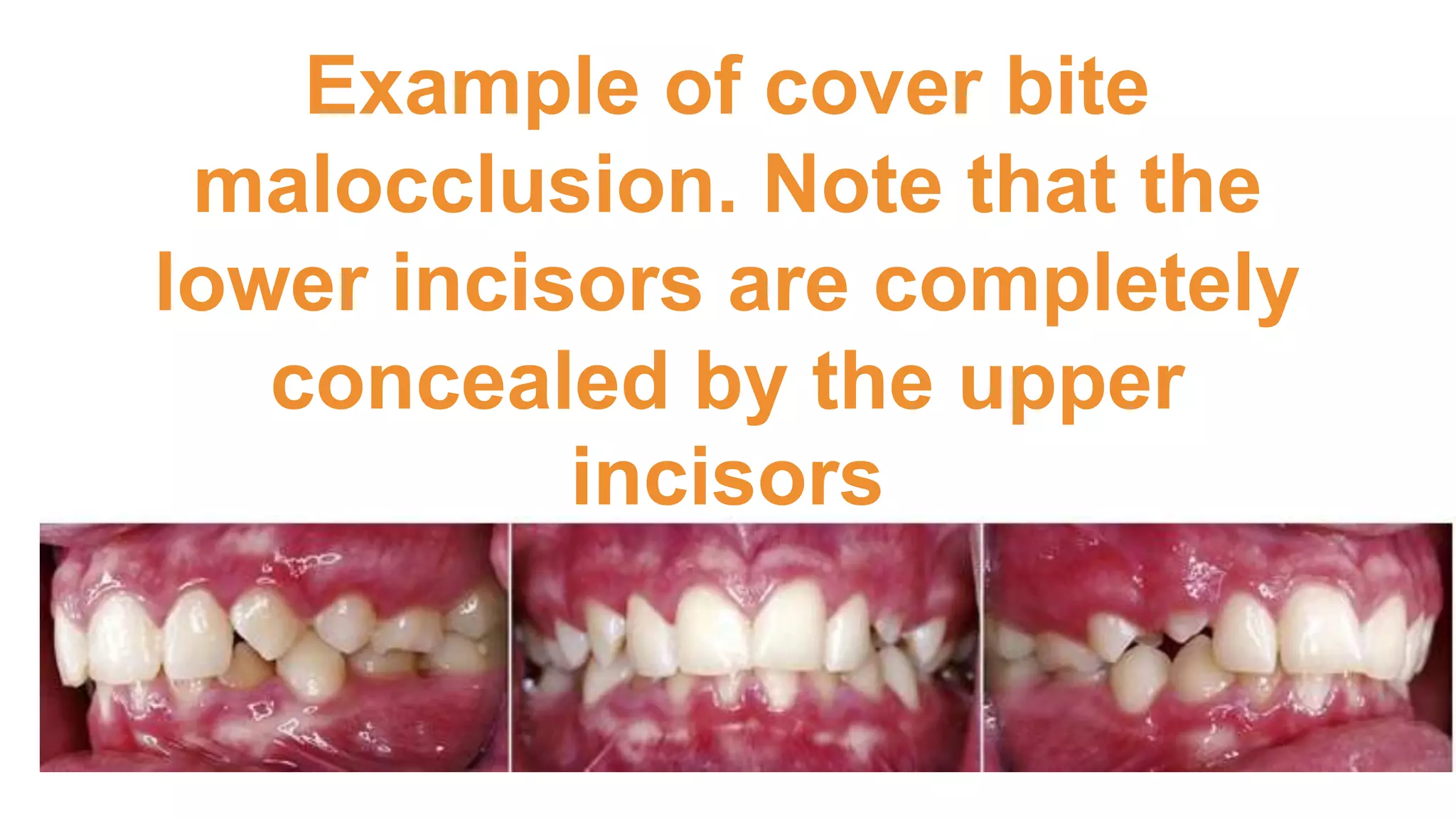 Orthodontic treatment of deep bite part 1 | PPTX