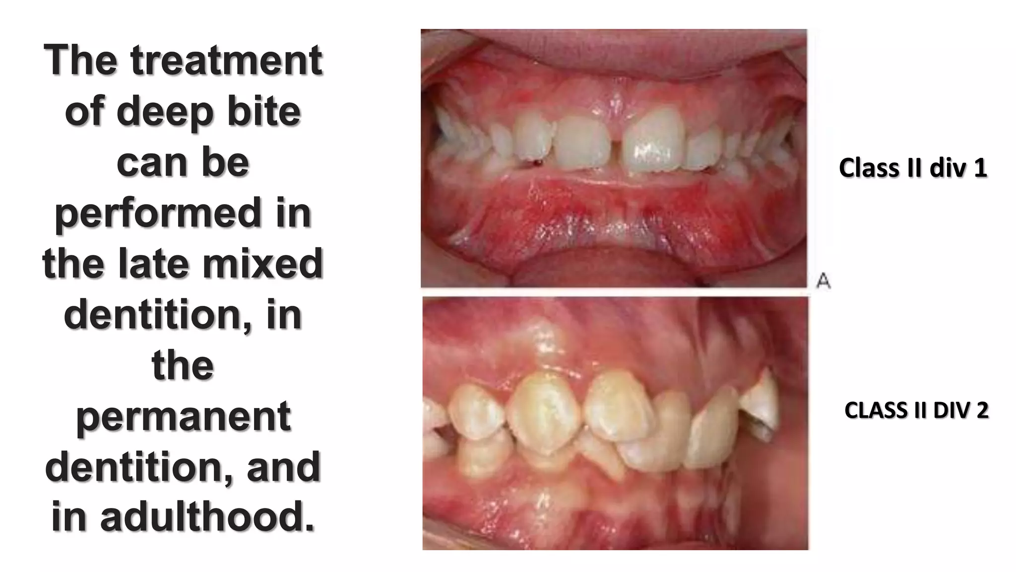 Orthodontic treatment of deep bite part 1 | PPTX