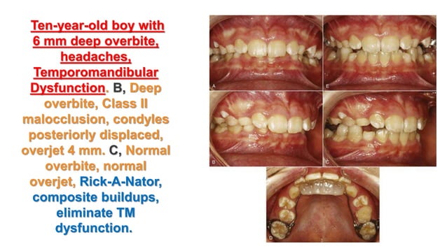 Orthodontic treatment of deep bite part 1 | PPTX | Oral care | Personal ...