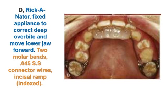 Orthodontic treatment of deep bite part 1 | PPTX | Oral care | Personal ...