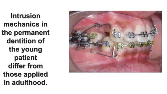 Orthodontic treatment of deep bite part 1 | PPTX | Oral care | Personal ...