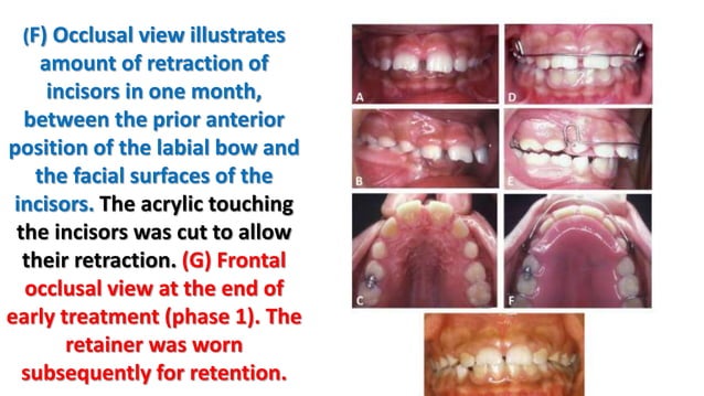 Orthodontic treatment of deep bite part 1 | PPTX | Oral care | Personal ...