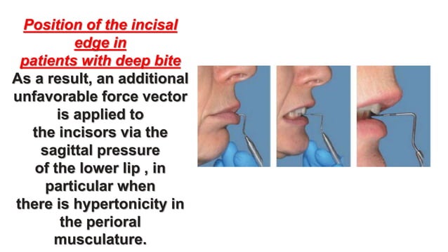 Orthodontic treatment of deep bite part 1 | PPTX | Oral care | Personal ...