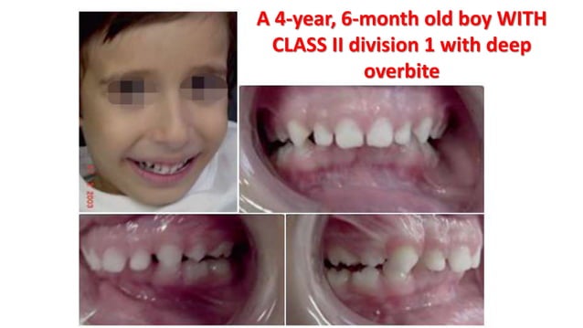 Orthodontic treatment of deep bite part 1 | PPTX | Oral care | Personal ...