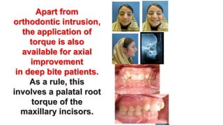 Orthodontic treatment of deep bite part 1 | PPTX