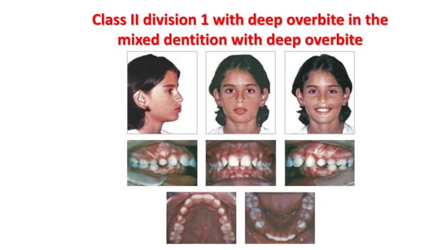 Orthodontic treatment of deep bite part 1 | PPTX | Oral care | Personal Care